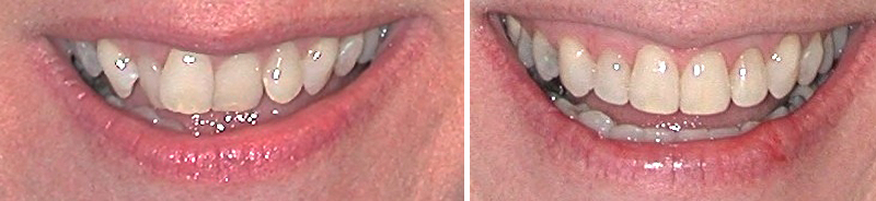 Before & After « The Tooth Mover