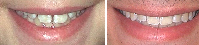 Before & After « The Tooth Mover