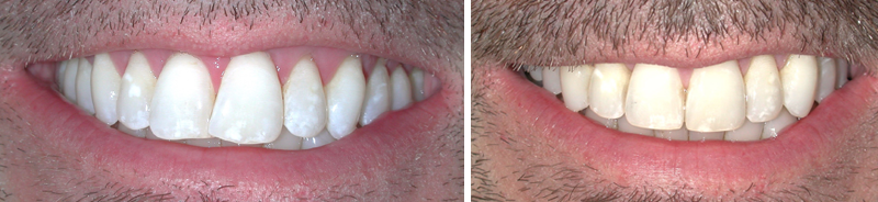 Before & After « The Tooth Mover